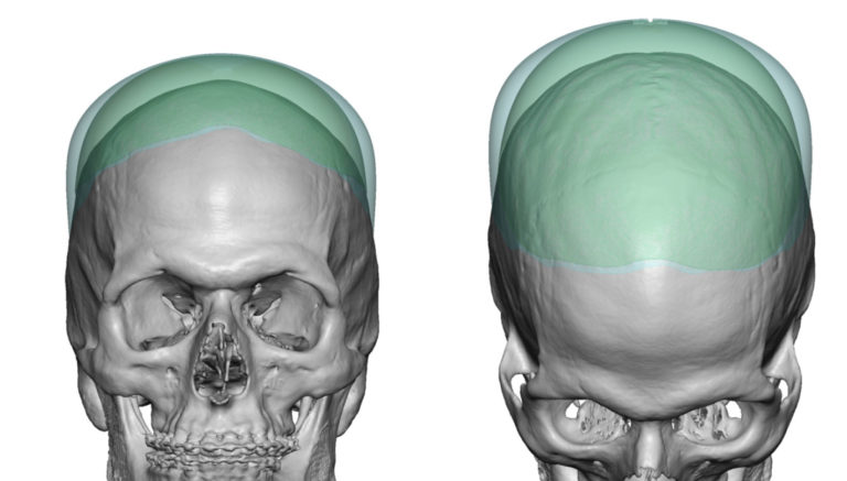 Plastic Surgery Case Study - Third Enlarging Custom Skull Implant ...