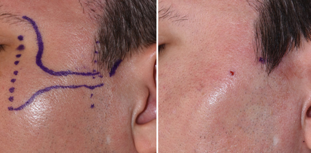 Technical Strategies - Percutaneous Zygomatic Arch Osteotomy Technique ...