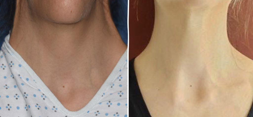 Webbed Neck Correction result front view Dr Barry Eppley Indianapolis ...