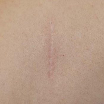 rib removal scar dr barry eppley indianapolis - Explore Plastic Surgery