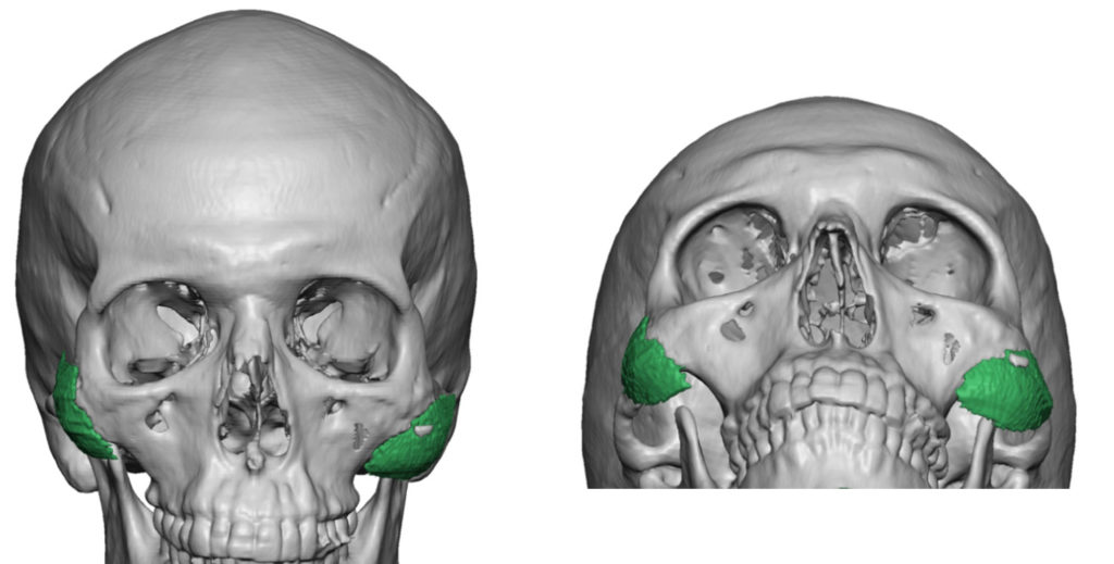 The Occurrence and Cause of Some Cheek Implant Asymmetry - Explore ...