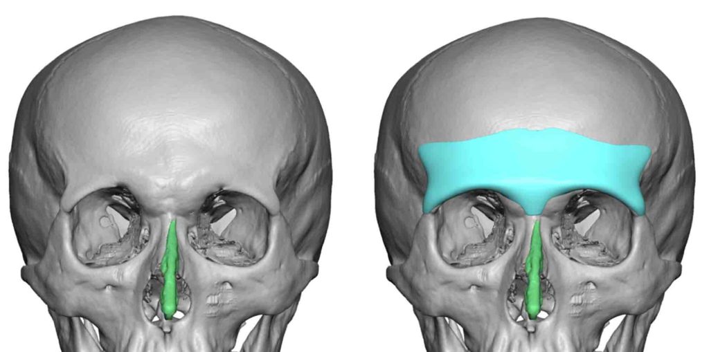 Plastic Surgery Case Study - Male Custom Brow Bone Implant Placement ...