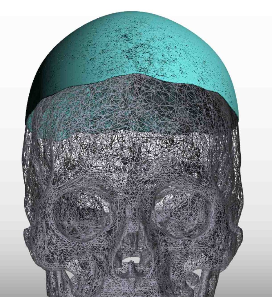 Plastic Surgery Case Study - Male Custom Skull Heightening Implant ...