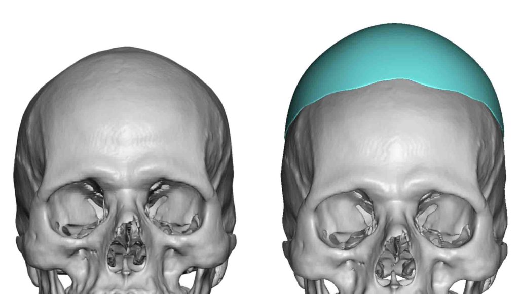 Plastic Surgery Case Study - Male Custom Skull Heightening Implant ...