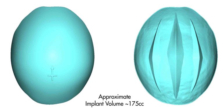 Plastic Surgery Case Study - Male Custom Skull Heightening Implant ...