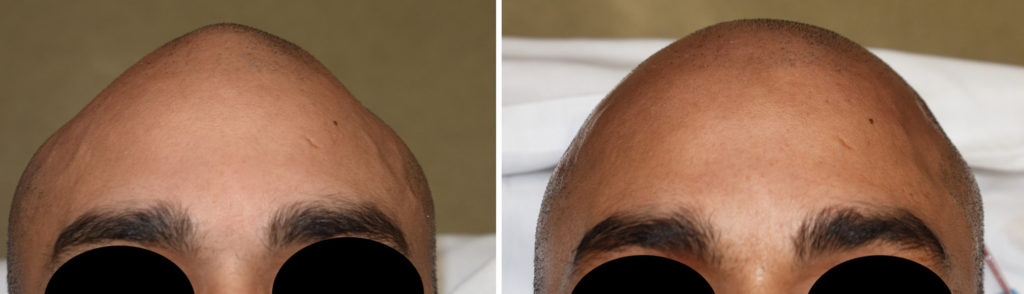 Plastic Surgery Case Study - Custom Skull Implant for Correction of ...