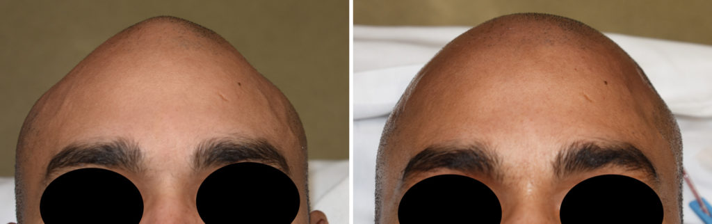 Custom Skull Implant for peaked head shape deformity Dr Barry Eppley ...