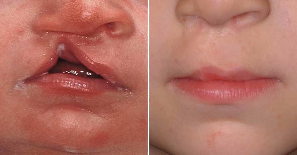 Plastic Surgery Case Study - Male Incomplete Cleft Lip Repair - Explore ...
