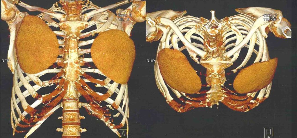Plastic Surgery Case Study - Correction of Male Pectoral Implant ...
