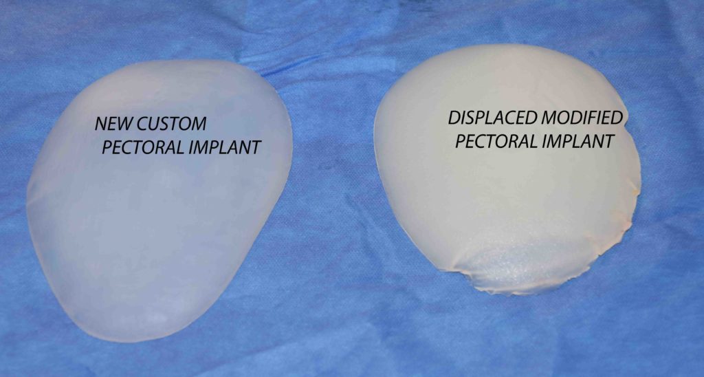 Plastic Surgery Case Study - Correction of Male Pectoral Implant ...