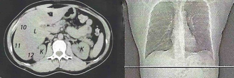 Rib Removal Anatomy and Internal Organs Dr Barry Eppley Indianapolis ...