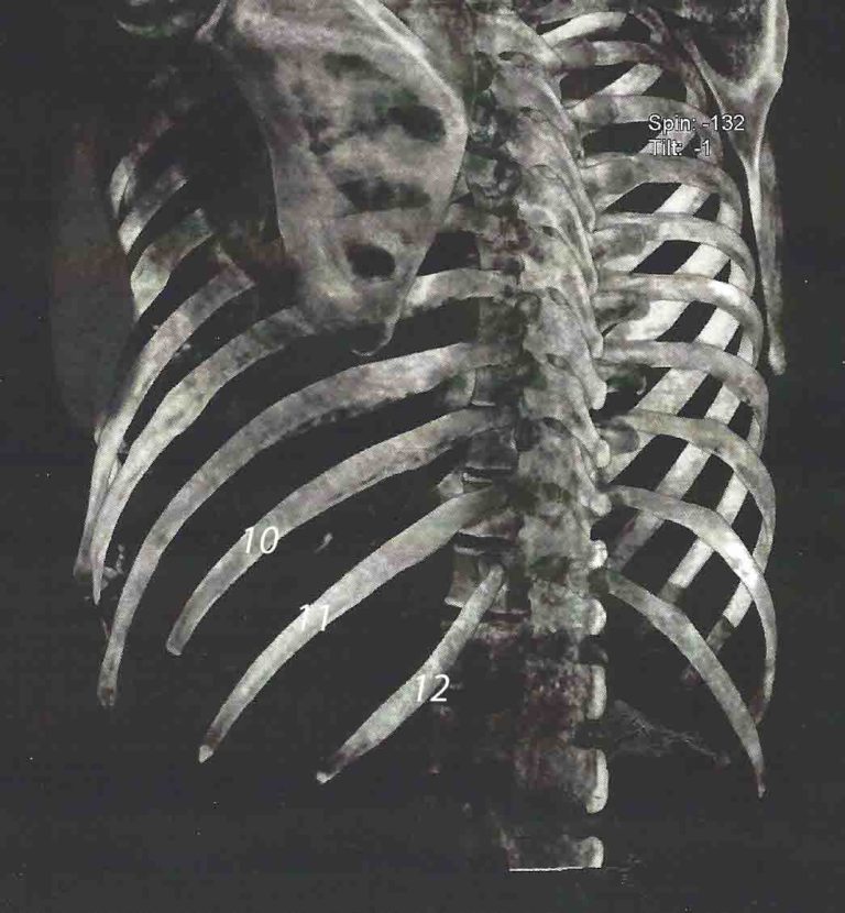 Understanding Rib Removal Surgery with 2D and 3D CT scans - Explore ...