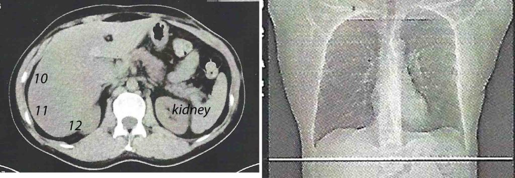 Understanding Rib Removal Surgery with 2D and 3D CT scans - Explore ...