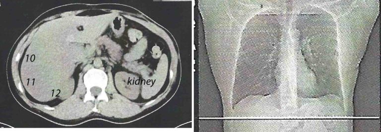 Understanding Rib Removal Surgery with 2D and 3D CT scans - Explore ...