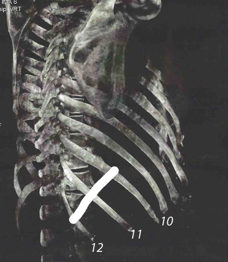 Rib Removal sections for horizontal waistline reduction 3D anatomy Dr ...