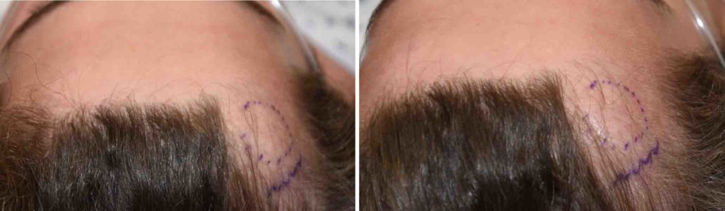 Plastic Surgery Case Study - Hairline Incisional Approach for Forehead ...