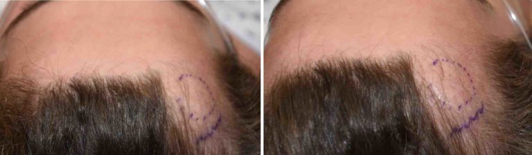 Plastic Surgery Case Study - Hairline Incisional Approach for Forehead ...