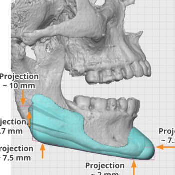 Plastic Surgery Case Study - Downsizing the Large Custom Jawline ...
