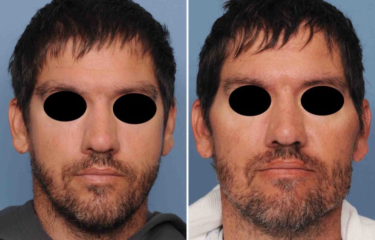 Plastic Surgery Case Study - Male Cheek-Arch Implants for the High ...