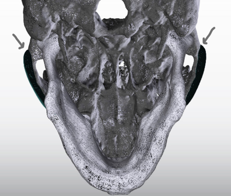 Implant Design Considerations for the High Cheekbone Look - Explore ...