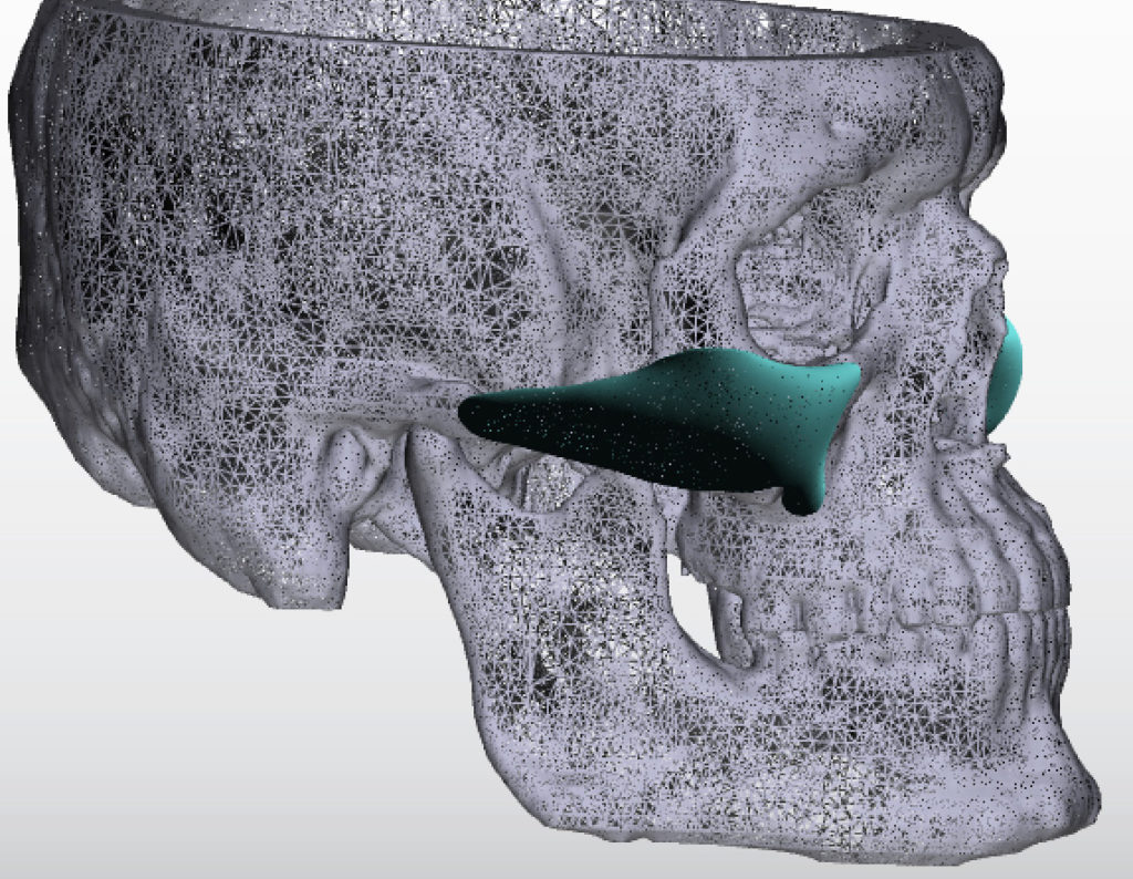 Implant Design Considerations for the High Cheekbone Look - Explore ...