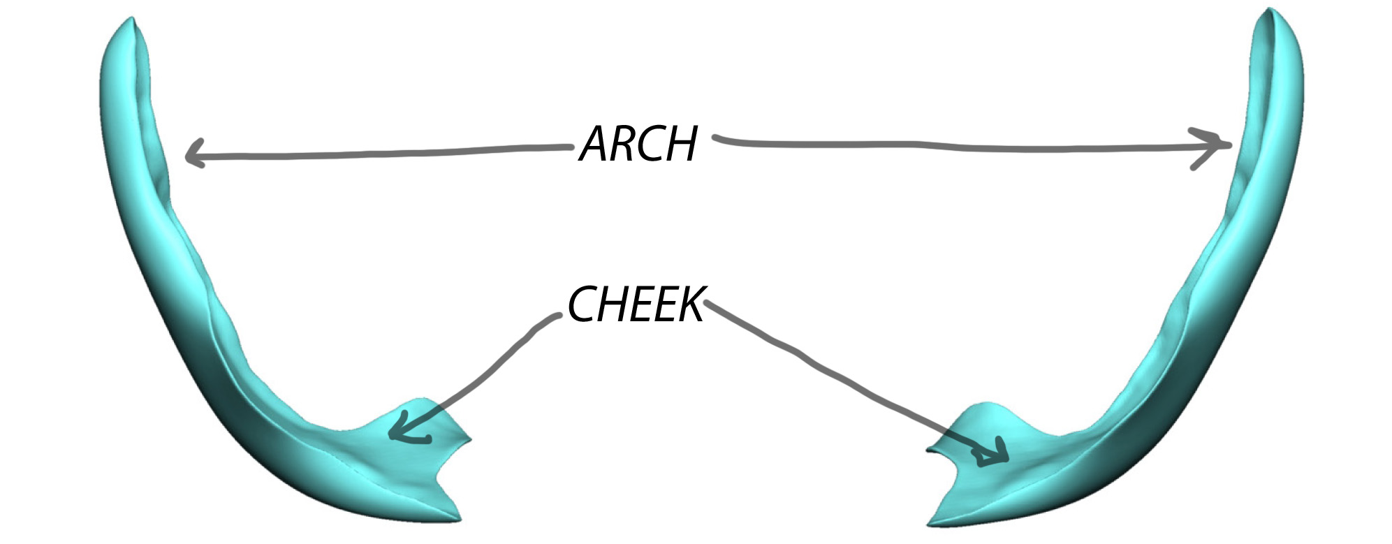 Implant Design Considerations for the High Cheekbone Look - Explore ...