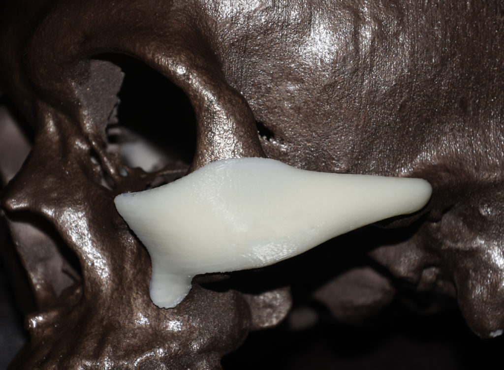 The Success of Cheek-Arch Implant Design Compared to Standard Cheek ...