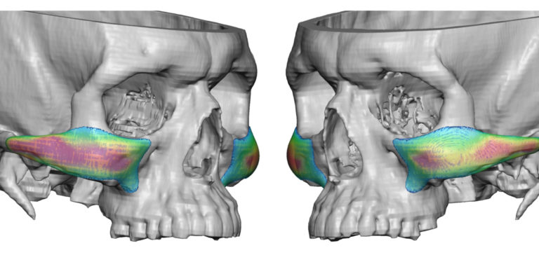 Implant Design Considerations for the High Cheekbone Look - Explore ...