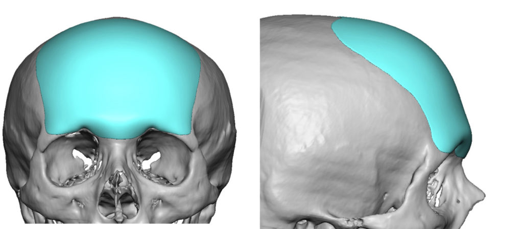 Material Options for Aesthetic Forehead Augmentation - Explore Plastic ...