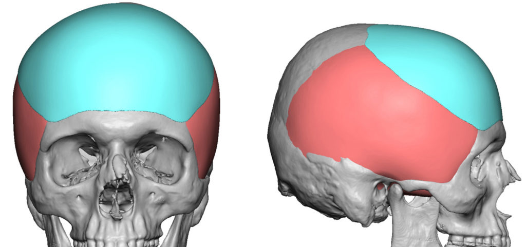 Material Options for Aesthetic Forehead Augmentation - Explore Plastic ...
