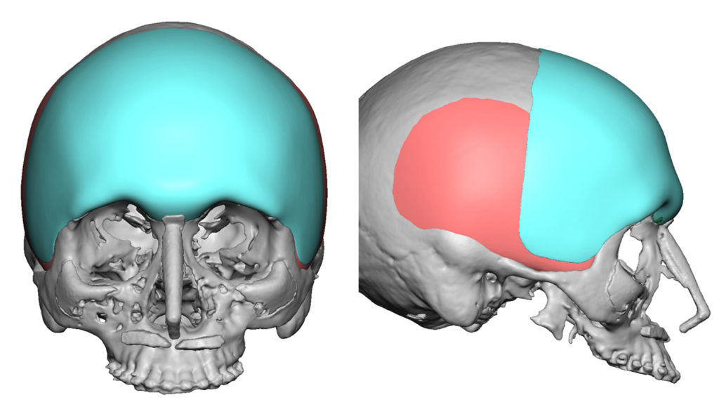 Material Options for Aesthetic Forehead Augmentation - Explore Plastic ...