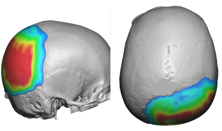 Plastic Surgery Case Study - Custom Skull Implant for Right Occipital ...