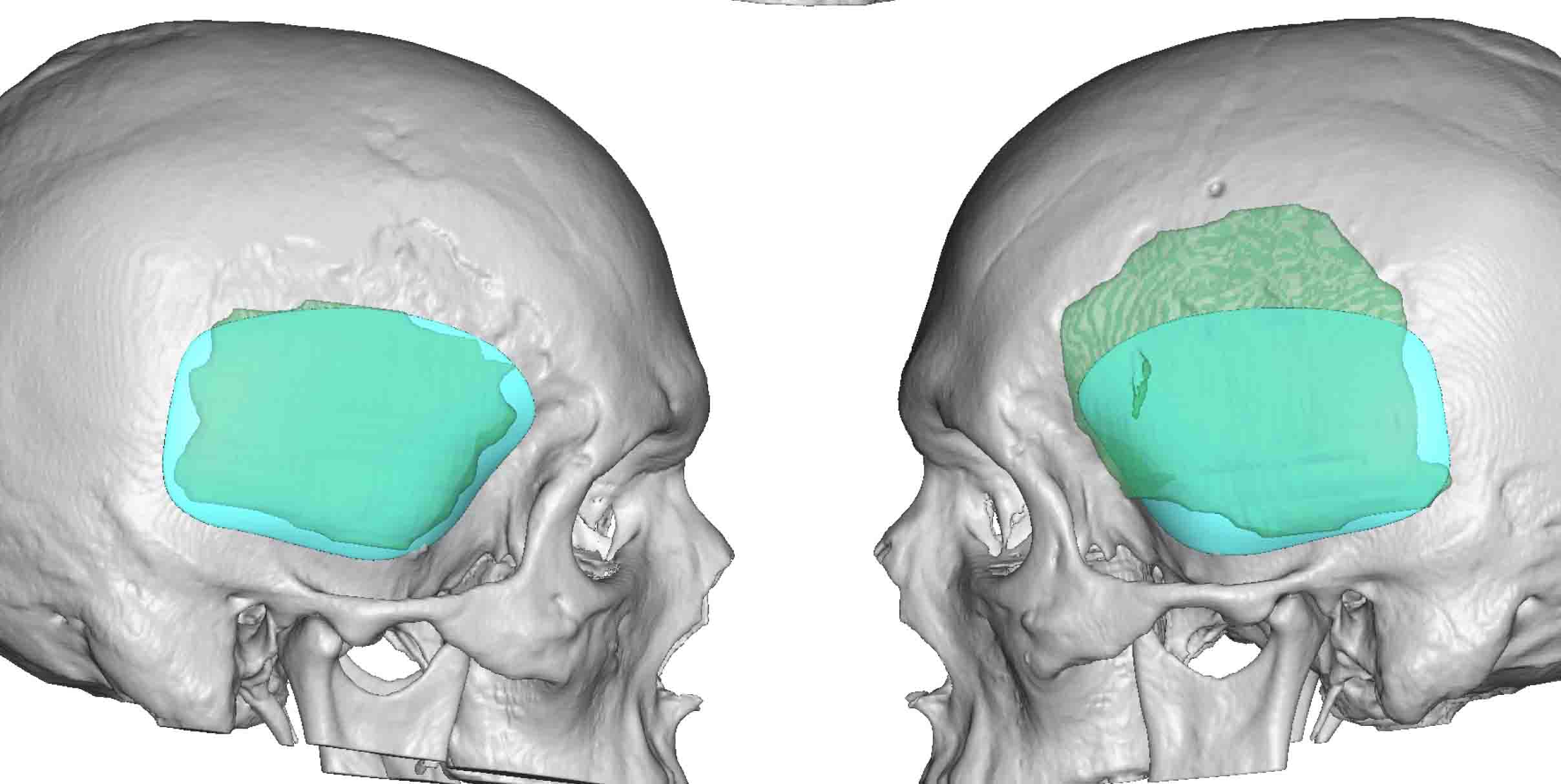 Custom Temporal Imlpant Replacements design side view Dr Barry Eppley ...