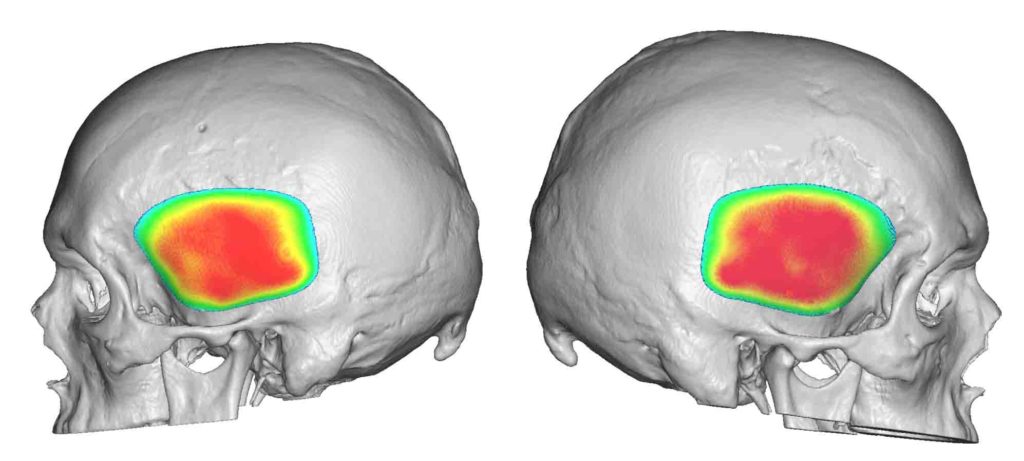 Custom Temporal Implants thicknesses Dr Barry Eppley Indianapolis ...