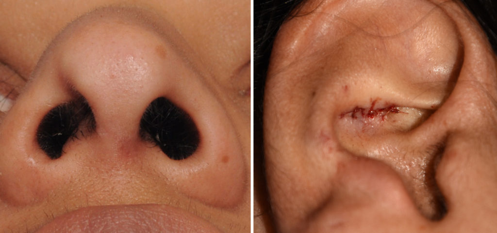 Plastic Surgery Case Study - Correction of Alar Rim Retraction with Ear ...