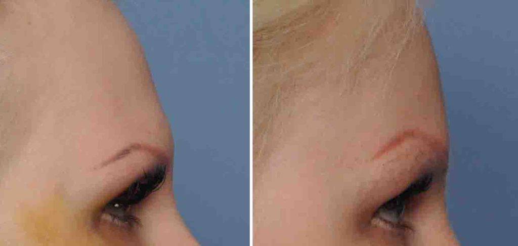 Concepts in Female Brow Bone Reduction - Explore Plastic Surgery