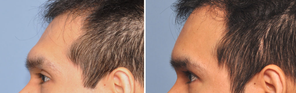 Concepts in Male Brow Bone Reduction - Explore Plastic Surgery