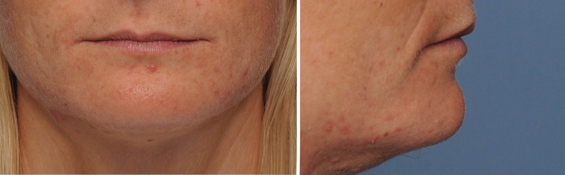 Plastic Surgery Case Study - Correction of the Undiagnosed Vertical ...