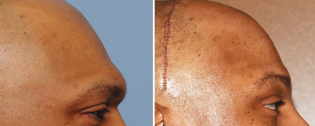 Concepts in Male Brow Bone Reduction - Explore Plastic Surgery