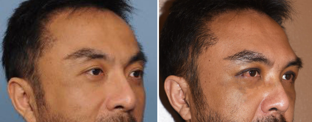 Custom Brow Bone Implants for Men - Explore Plastic Surgery