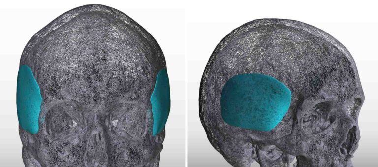 Plastic Surgery Case Study - Custom Temporal Implants Replacement of ...