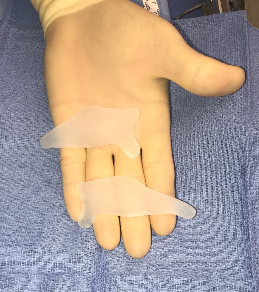 Model Cheek Implants in hand intraop - Explore Plastic Surgery