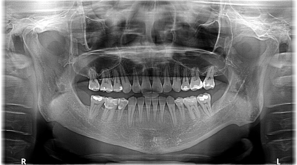 The Inferior Border Shave in Lower Facial Asymmetry Correction ...