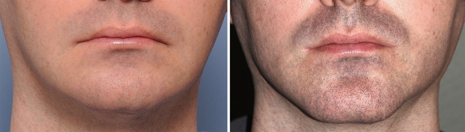 Avoiding Aesthetic Chin Implant Complications III. Square Chin ...
