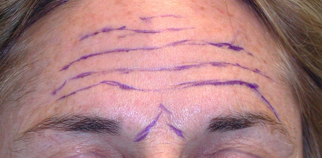 Outcome Assessment of Glabellar Myectomies in Endoscopic Browlifts ...