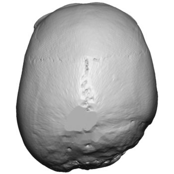 Plastic Surgery Case Study - Custom Skull Implant for Right Occipital ...