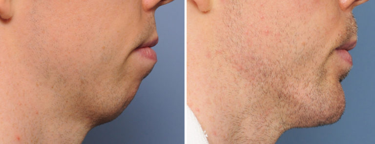 The Aesthetic Effects of Blended (Extreme) Chin Augmentation - Explore ...
