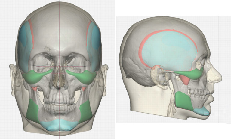 Plastic Surgery Case Study - Custom Temporal Implants for a Head ...