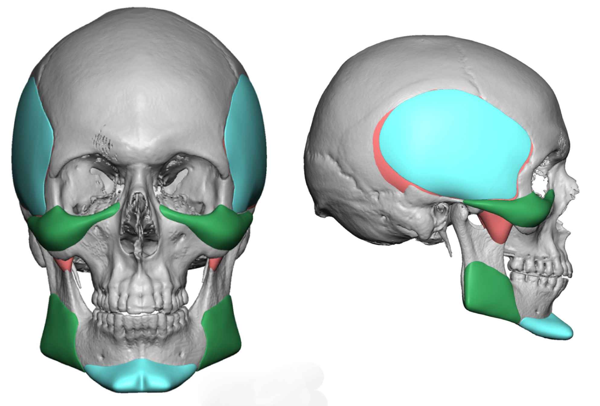 Plastic Surgery Case Study - Custom Temporal Implants for a Head ...