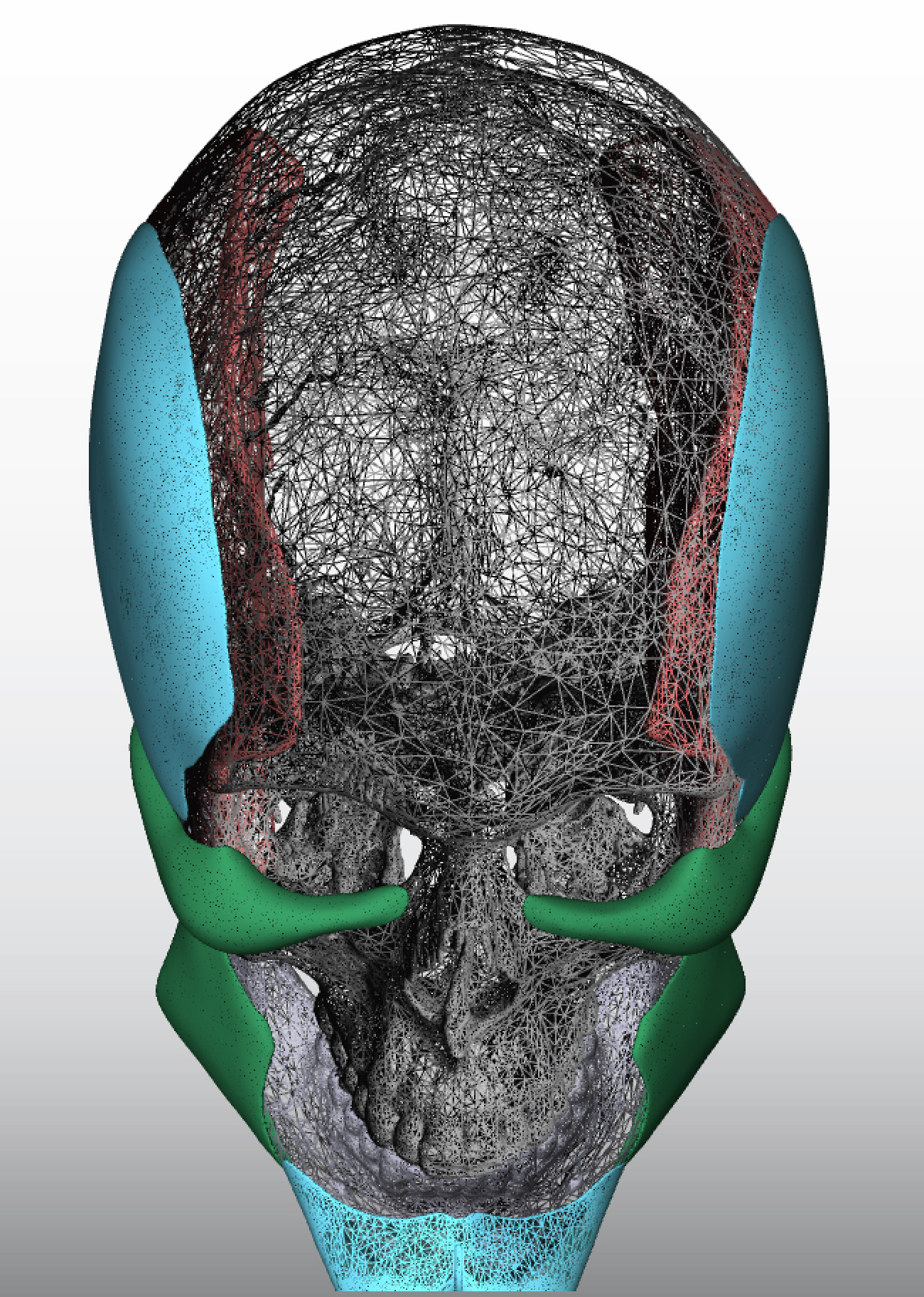 Custom Temporal Implants 3D design top view Dr Barry Eppley ...